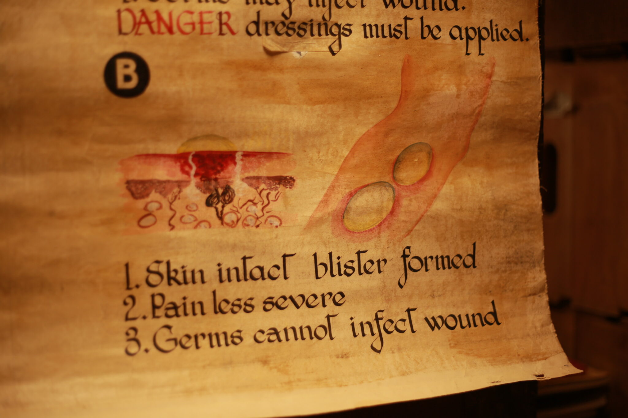 Hand-painted Burns Medical Chart - On The Square Emporium
